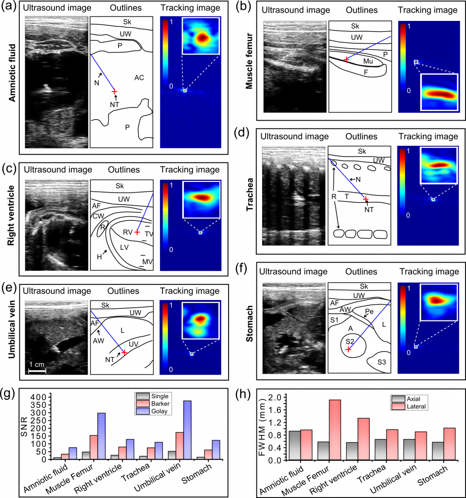 Ultrasonic needle tracking for guiding fetal interventions - GIFT-Surg ...